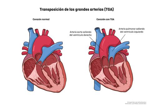 Transposición De Grandes Arterias Escola Salut Sjd