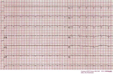 QRS Axis And Voltage Wikidoc