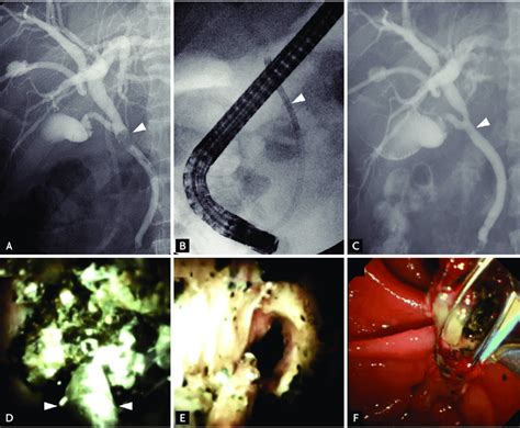 Single Operator Cholangioscopy Soc Guided Electrohydraulic Download Scientific Diagram