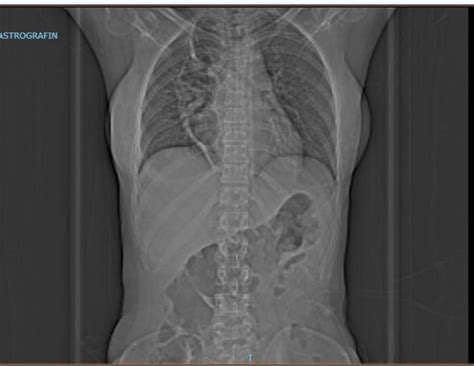 Felice Pirozzi On Linkedin Esophago Colonplasty In A Patient With Caustic Esophageal Stricture…