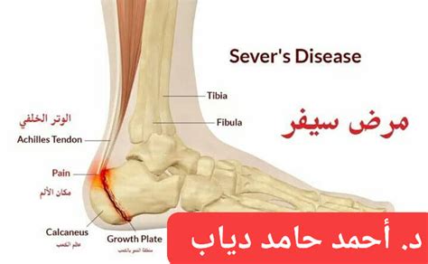 مرض سيڤر Severs Disease مرض سيفر هو مرض يظهر عادة في مرحلة البلوغ