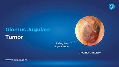 Glomus Jugulare Tumor Symptoms Diagnosis And Treatment