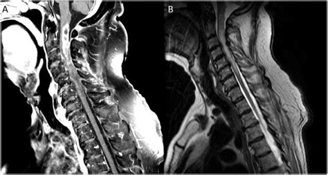 Mri T1 Weighted Imaging Revealing Spinal Cord Hypoattenuation At The Download Scientific
