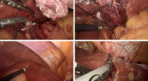 Surgical Laparoscopy Endoscopy And Percutaneous Techniques