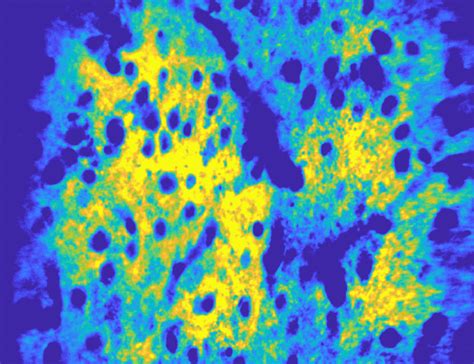 Cortical Hyperexcitability In Mouse Models And Patients With Amyotrophic Lateral Sclerosis Is