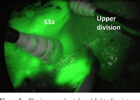 Figure 1 From A Case Of Thoracoscopic Extended Segmentectomy Using Infrared Thoracoscopy With
