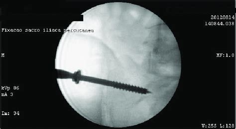 Percutaneous Fixation Technique Placement Of Cannulated Screw With Download Scientific