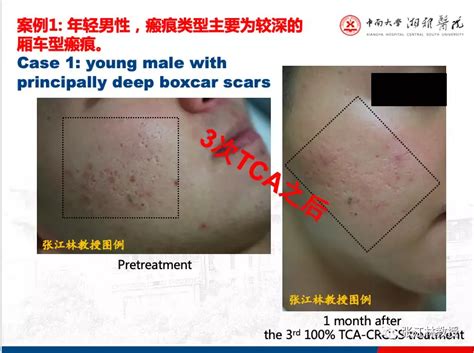 Tca Cross治疗详解：安全、有效、经济治疗痤疮凹陷性瘢痕张江林主任医师爱问健康