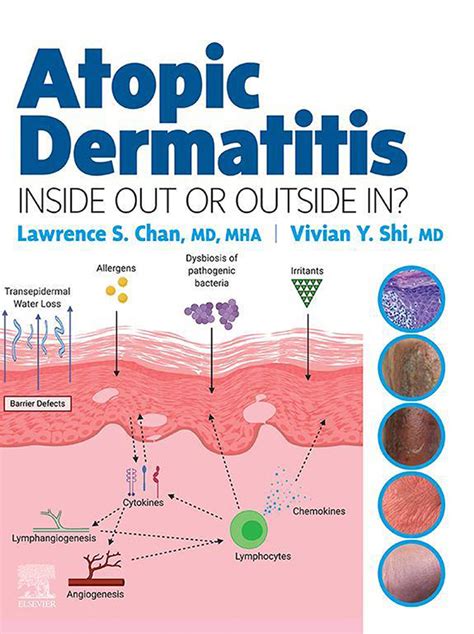 Atopic Dermatitis Inside Out Or Outside In E Book Premiumjs Store