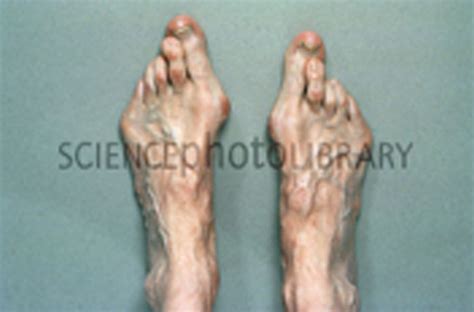 Marfan Syndrome