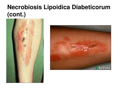 Ppt Skin Disorders Of Diabetes Mellitus Powerpoint Presentation Free