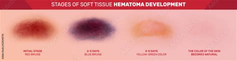 Hematoma Development Stages Set Stock Vector Adobe Stock