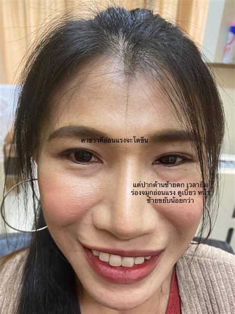 คนไข้อายุแค่28 ปี เริ่มมีอาการจาก ปวดคอ แขนขวาไม่ค่อย มีแรงมา 3 ปี