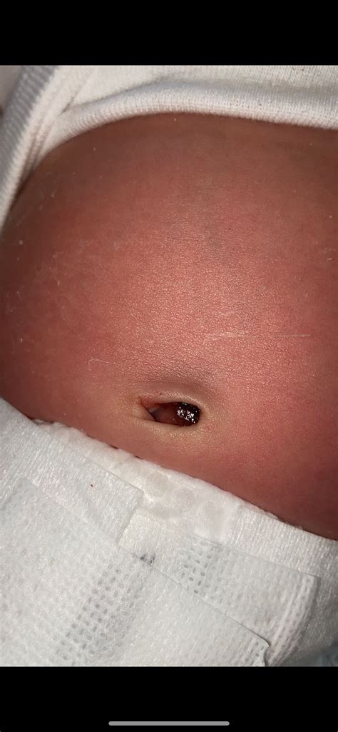 Belly Button Infection BabyCenter