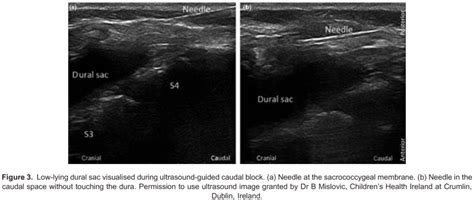 Ultrasound Guided Caudal Anaesthesia Wfsa Resources