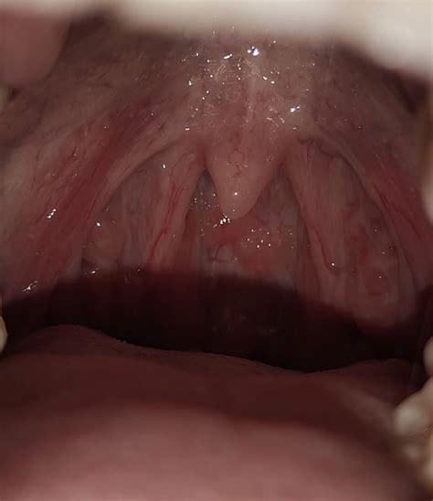 Tonsil Crypts And Stones Are Ruining My Life Rtonsilstones