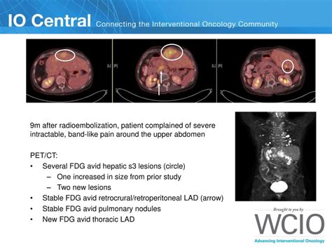 Multi Modality Approach To Managing Intrahepatic Cholangiocarcinoma Ppt Download