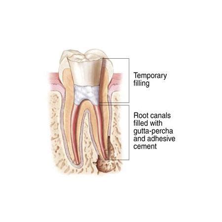 Post And Core Build Up Before After Photos Richardson Texas