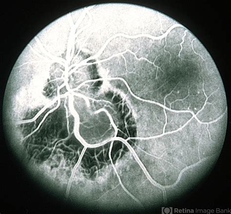 Toxocara Granuloma Retina Image Bank
