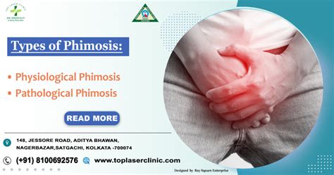 Understanding Phimosis Description Symptoms Types Causes And Treatment