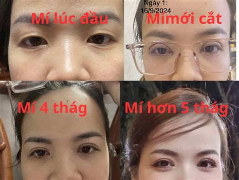 HỘi CẮt MÍ NhẤn MÍ SỬa MÍ LỖi HỎng Mí được 5 Tháng Cũng Bớt Lo Rồi Mọi Người ạ