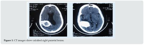 Recurrent Calcified Hydatid Brain Cyst Case Report