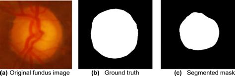 Worst Case Of Optic Cup Segmentation Download Scientific Diagram