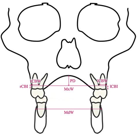 Tooth Bone Borne Vs Bone Borne Rapid Maxillary Expanders Jmdh