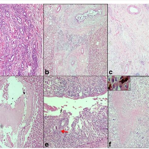 A Bile Ductular Proliferation B Fibrous Expansion Of Portal Tracts