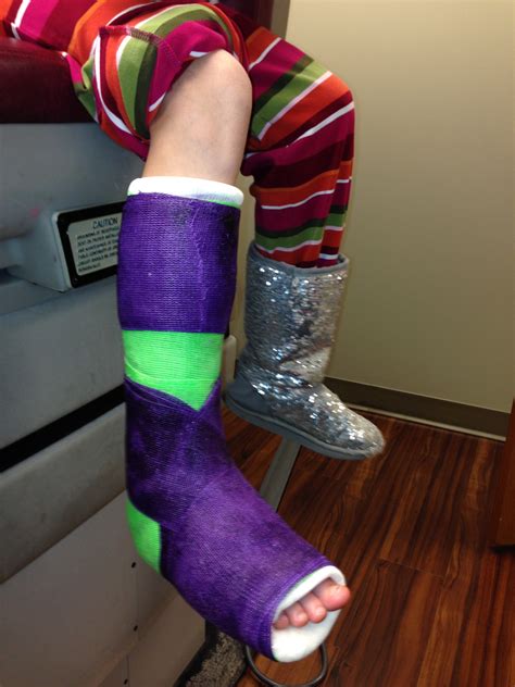 Accessory Navicular Surgery Recovery At Jai Reading Blog