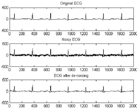 Figure 4 From Denoising Of Ecg Signals Using Empirical Mode Decomposition Based Technique