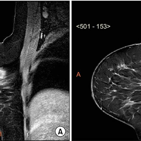Pdf Intramammary Sentinel Lymph Node With Capsular Extravasation In Breast Cancer