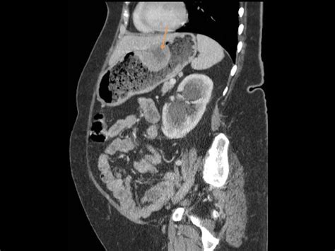 Gist They Are Frequently Exophytic Typically The Mass Is Of Soft