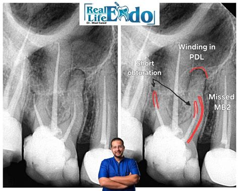 Anatomical Apex Vs Radiogrphic Apex When To Trust Your Apex Locator 🤔 Almost Every Dentist