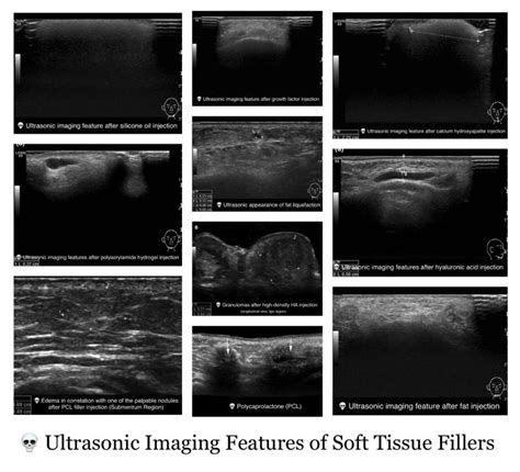 💀 Ultrasound Patterns Of Different Soft Tissue Filler Materials Used In Aesthetics Yousef