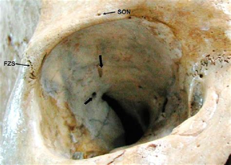 Anterior View Of The Right Orbit With Two Meningo Orbital Foramen Download Scientific Diagram