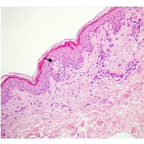 Diffuse Itchy Maculopapular Rash Download Scientific Diagram
