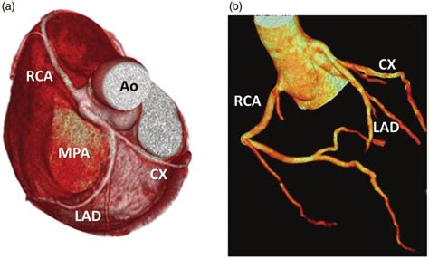 Multidetector Computed Tomography A Preoperatively The Anomalous Download Scientific