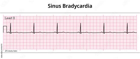 Ecg Sinus Bradycardia 8 Second Ecg Paper Stock Vector Adobe Stock