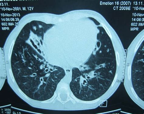 Cylindrical Bronchiectasis Download Scientific Diagram