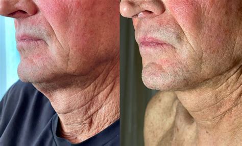 КОСМЕТОЛОГ ХАБАРОВСК Подтяжка лица без операции🔥 ⠀ После 30 гравитация берет верх и наше лицо