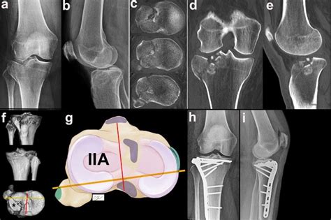 Schatzker Classification Tibial Plateau Fracture Rxharun