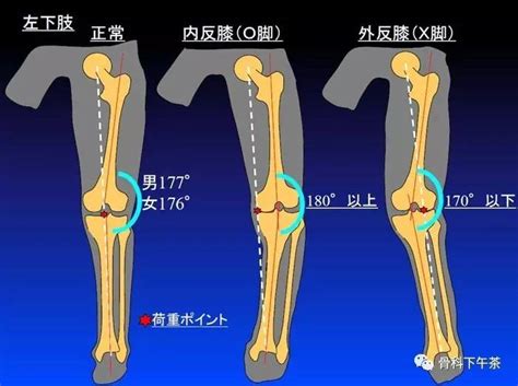 膝关节内翻测量 膝关节内翻和外翻 大山谷图库