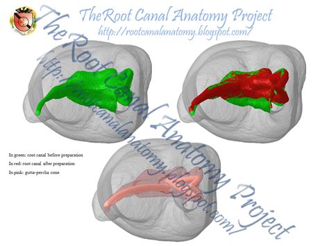 The Root Canal Anatomy Project Conservative Endodontic Access