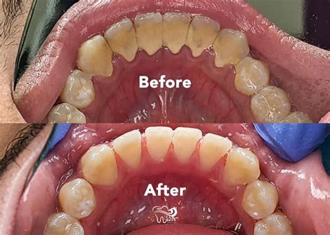 Deep Cleaning Teeth Cost How Much Preparation Is Required 60 Off