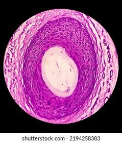 22 Cutaneous Calcification Images Stock Photos Vectors Shutterstock