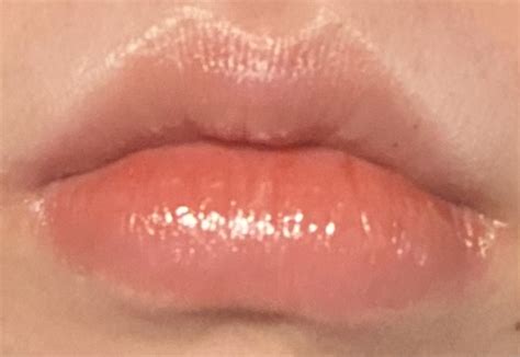 시술 수술 질문 입술필러 안 녹이고 강남언니 1등 성형수술and피부시술 정보앱