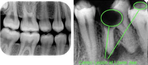 Dental Caries X Ray