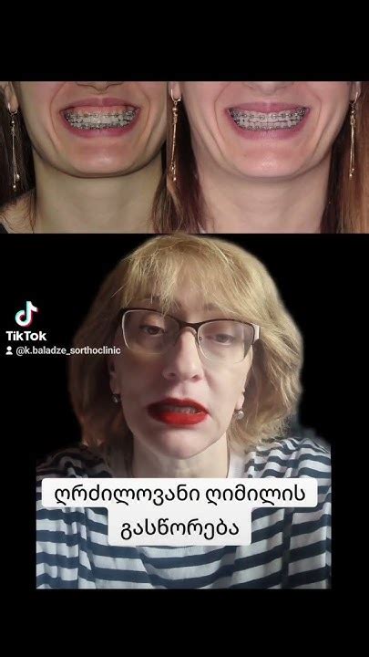 ღრძილოვანი ღიმილის კორექცია Youtube