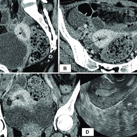 Patterns Of Uterine Enhancement Seen On 64 Slice Multidetector Computed Download Scientific